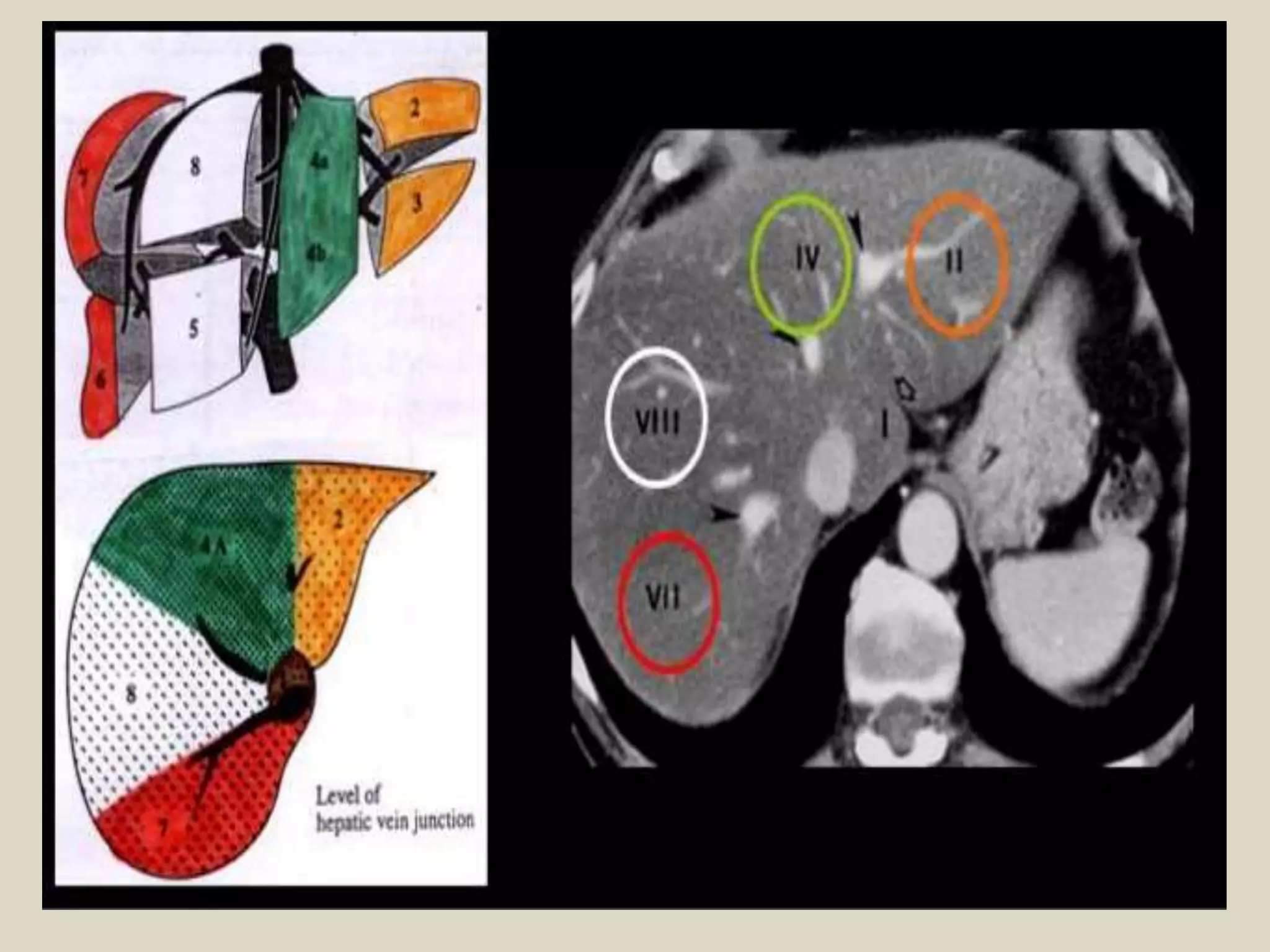 Presentation2, radiological anatomy of the liver and spleen. | PPTX