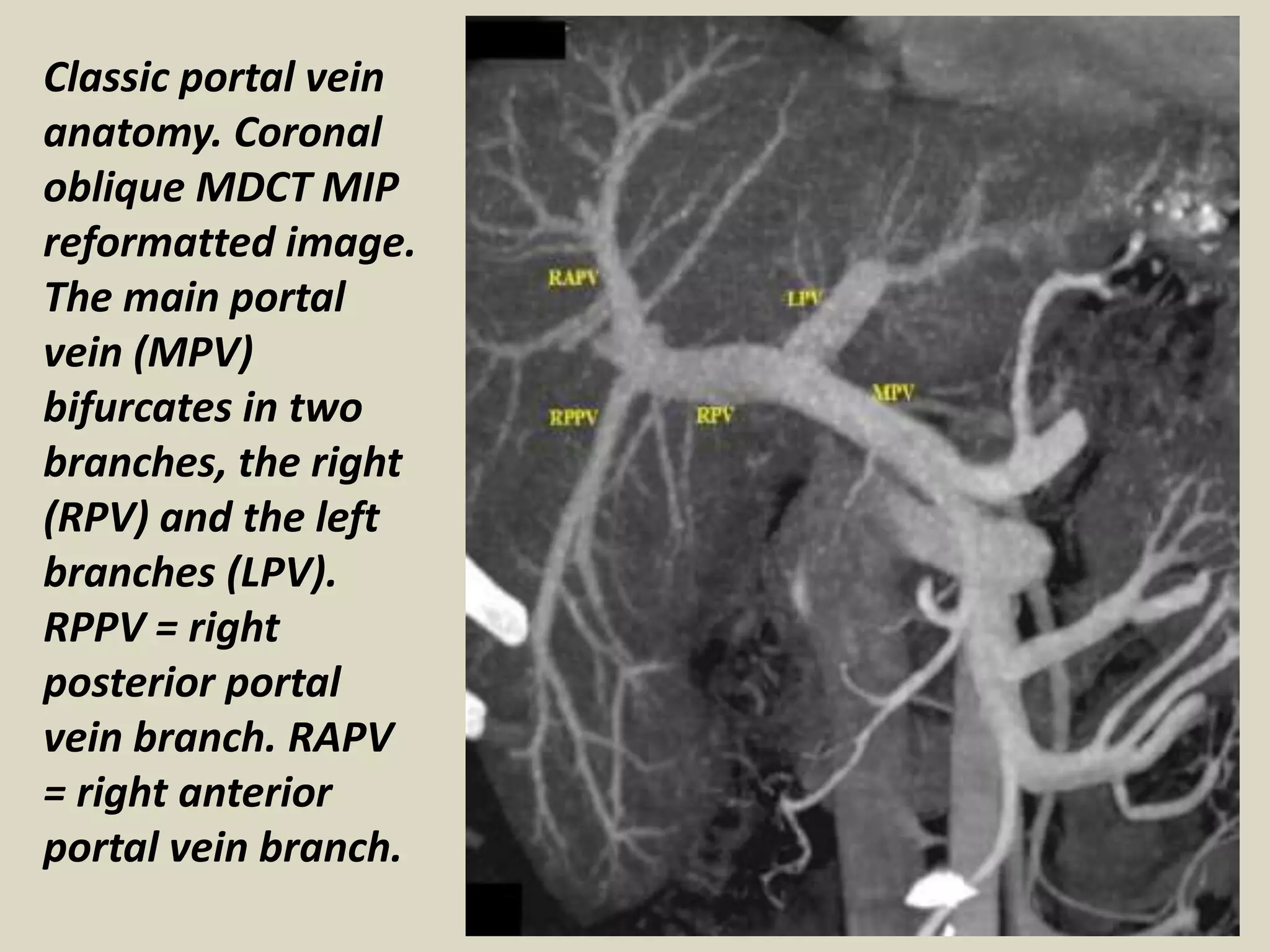 Presentation2, radiological anatomy of the liver and spleen. | PPTX