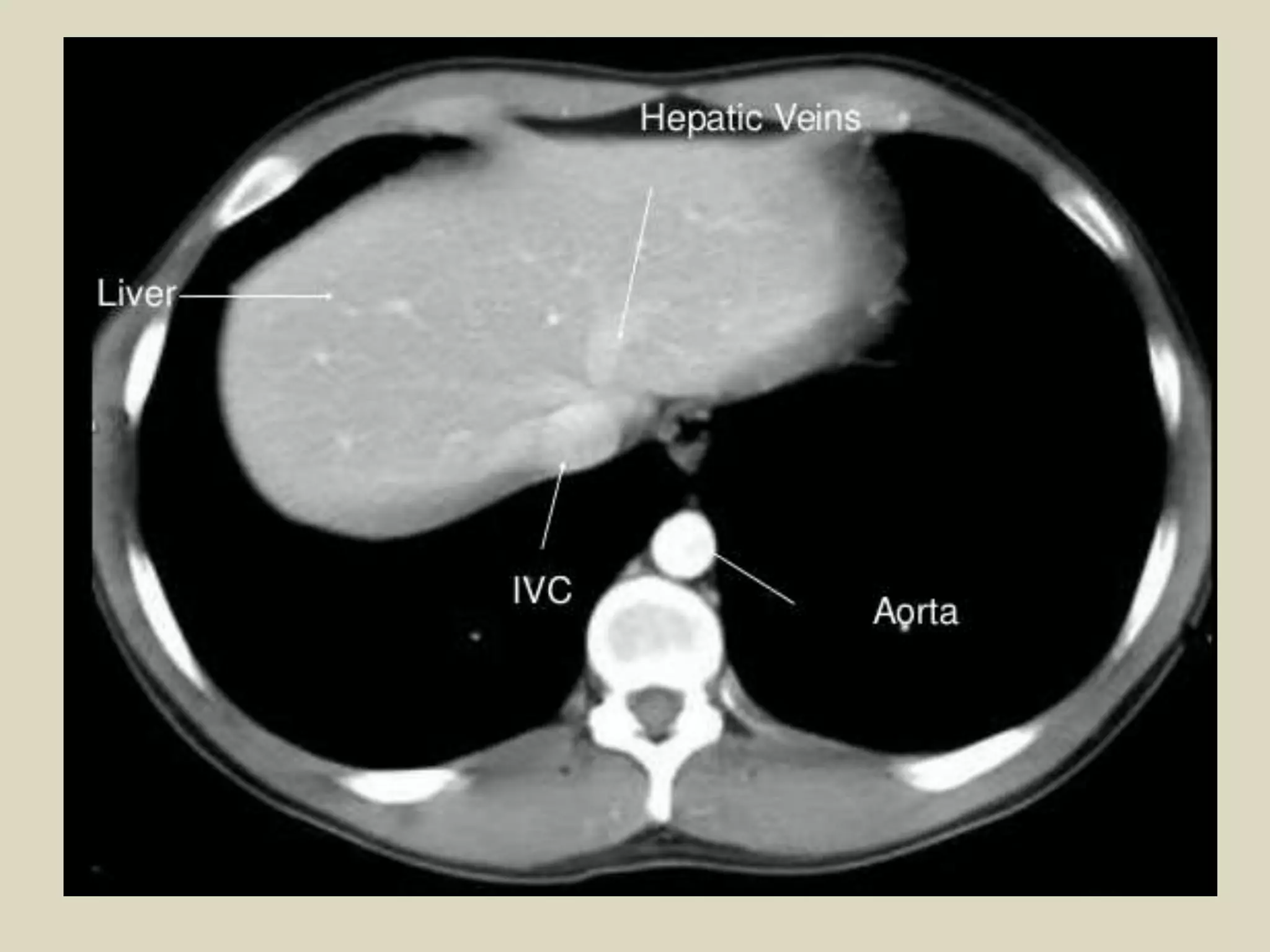 Presentation2, radiological anatomy of the liver and spleen. | PPTX