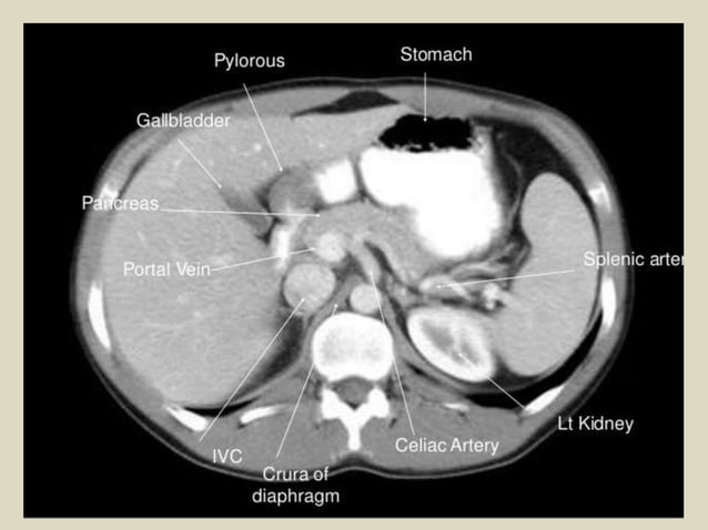 Presentation2, radiological anatomy of the liver and spleen.