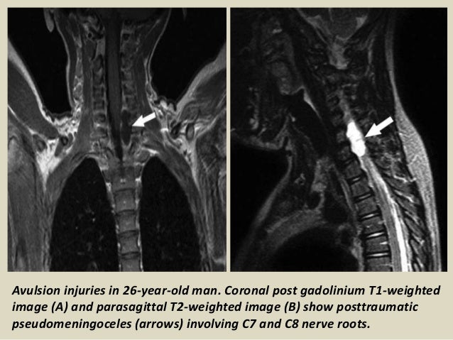 Brachial Plexus Mri Scan