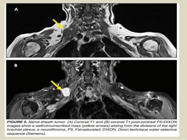 Presentation2, radiological imaging of brachial plexus pathology.
