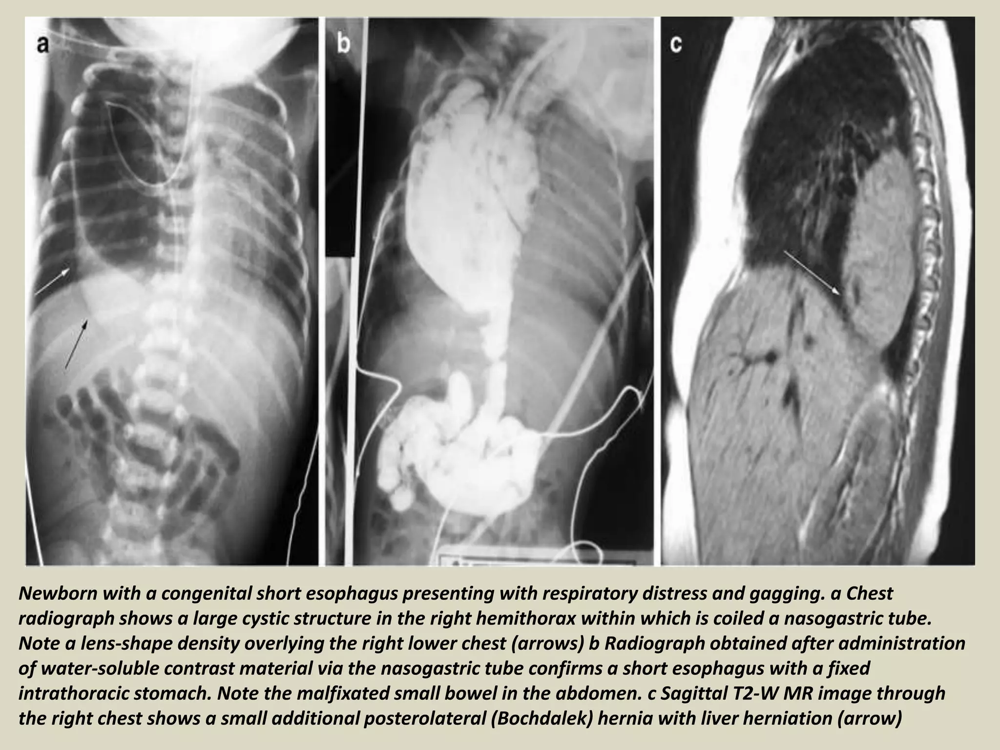 Presentation2, radiological imaging of diaphagmatic hernia. | PPTX