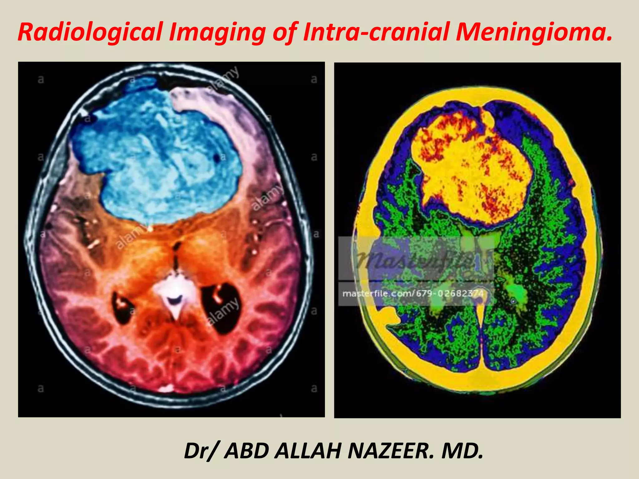Presentation2, radiological imaging of intra cranial meningioma. | PPT