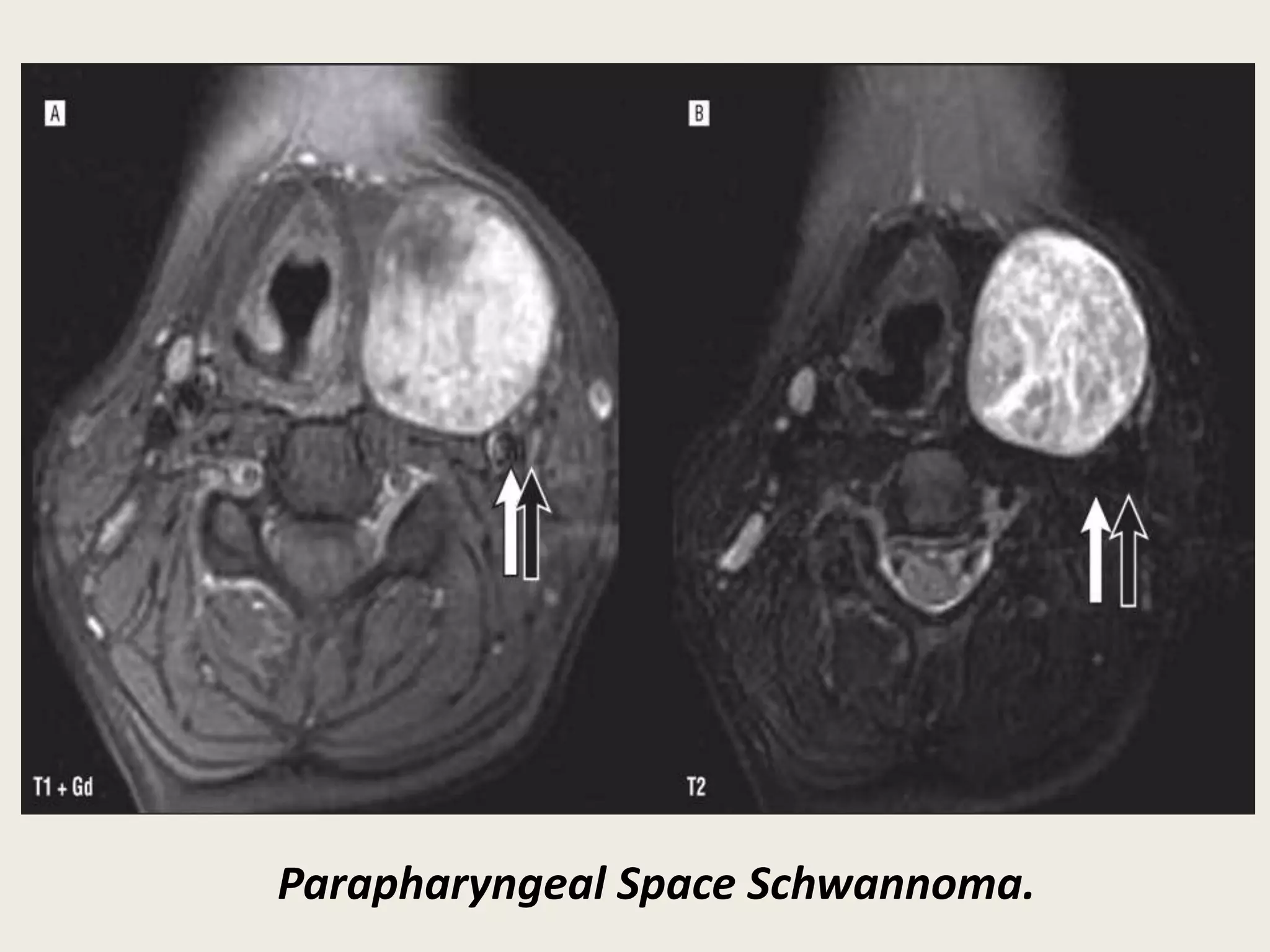 Presentation2, radiological imaging of neck schwannoma. | PPTX