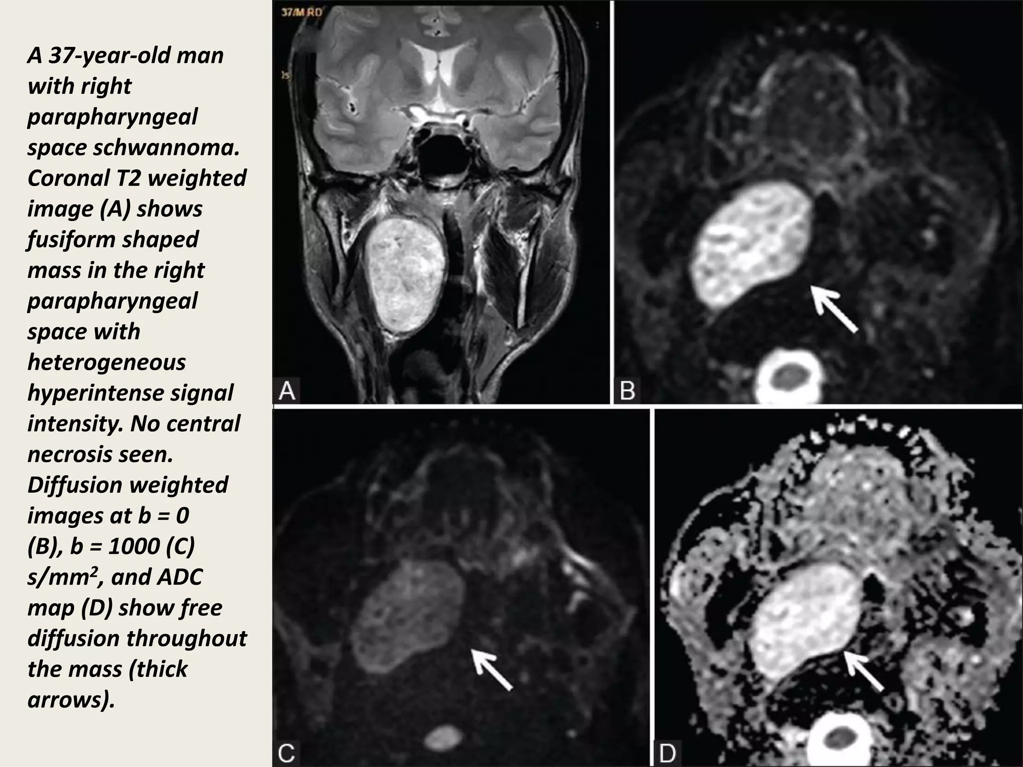 Presentation2, radiological imaging of neck schwannoma. | PPTX