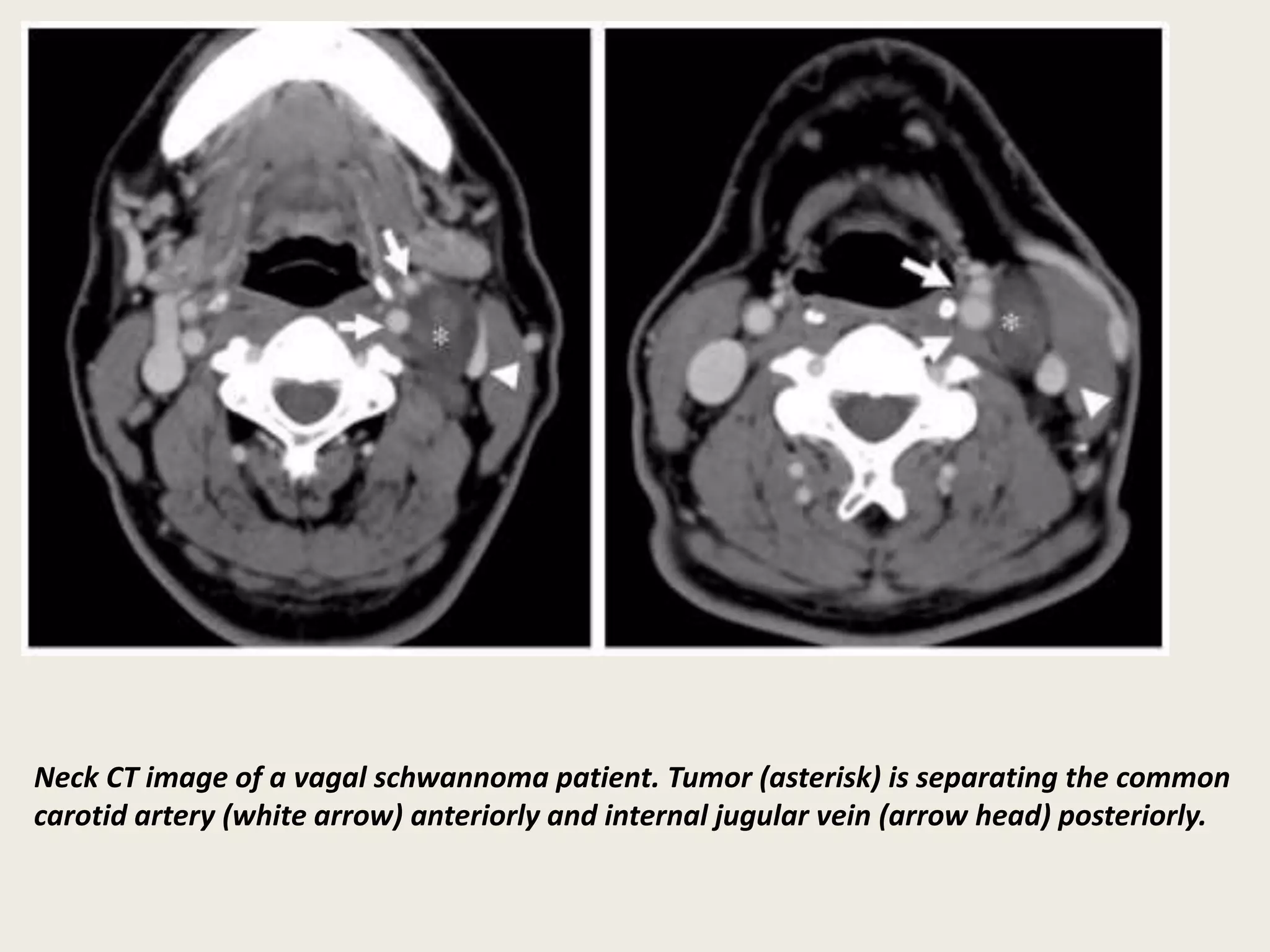 Presentation2, radiological imaging of neck schwannoma. | PPTX