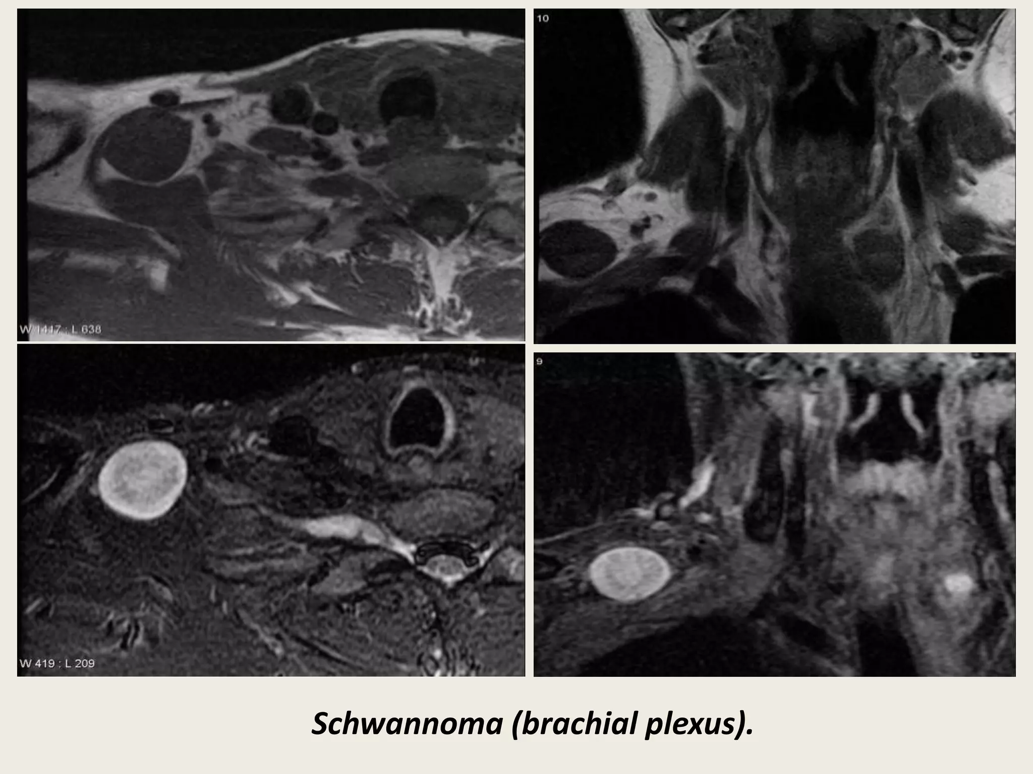 Presentation2, radiological imaging of neck schwannoma. | PPTX