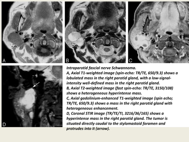 Presentation2, radiological imaging of neck schwannoma. | PPTX | Ear ...
