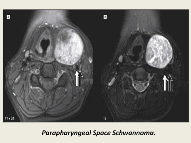 Presentation2, radiological imaging of neck schwannoma. | PPTX | Ear ...