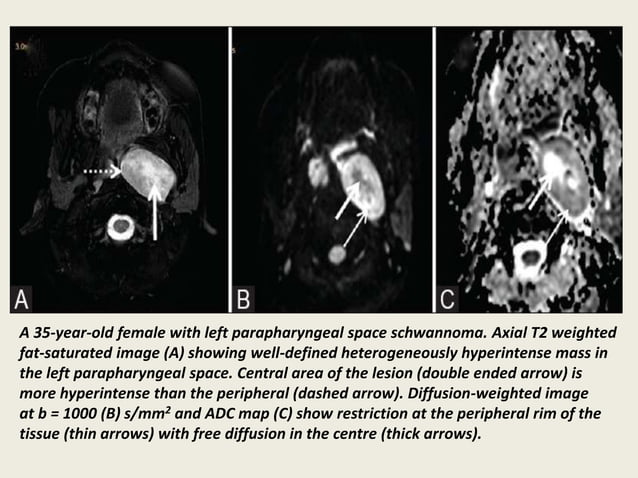 Presentation2, radiological imaging of neck schwannoma. | PPTX | Ear ...