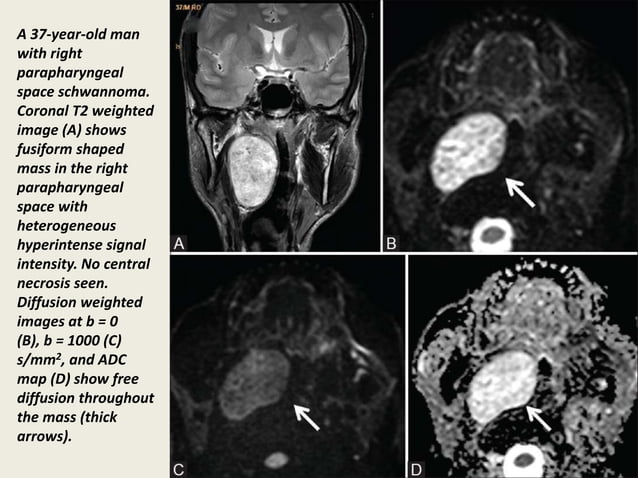 Presentation2, radiological imaging of neck schwannoma. | PPTX | Ear ...