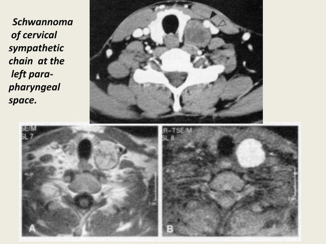 Presentation2, radiological imaging of neck schwannoma. | PPTX | Ear ...