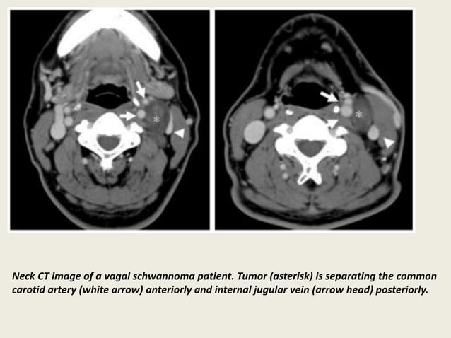 Presentation2, radiological imaging of neck schwannoma. | PPTX | Ear ...
