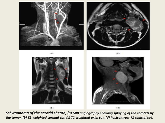 Presentation2, radiological imaging of neck schwannoma. | PPTX | Ear ...