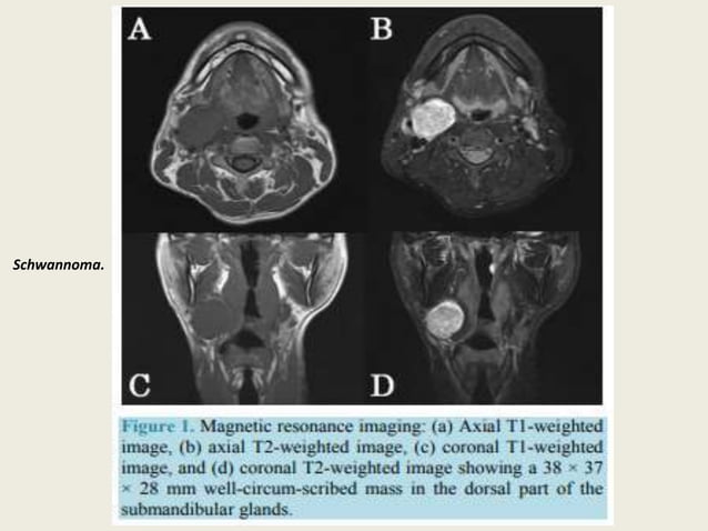 Presentation2, radiological imaging of neck schwannoma. | PPTX | Ear ...