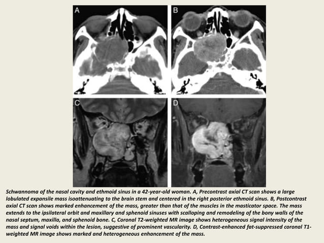 Presentation2, radiological imaging of neck schwannoma. | PPTX | Ear ...