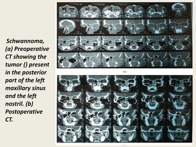 Presentation2, radiological imaging of neck schwannoma. | PPTX | Ear ...