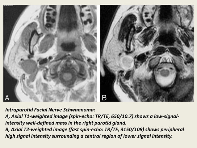 Presentation2, radiological imaging of neck schwannoma. | PPTX | Ear ...