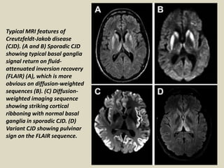 Presentation2, radiological imaging of neurodegenerative and dementai ...