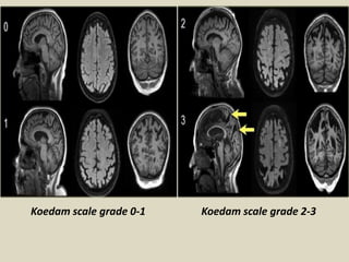 Presentation2, radiological imaging of neurodegenerative and dementai ...
