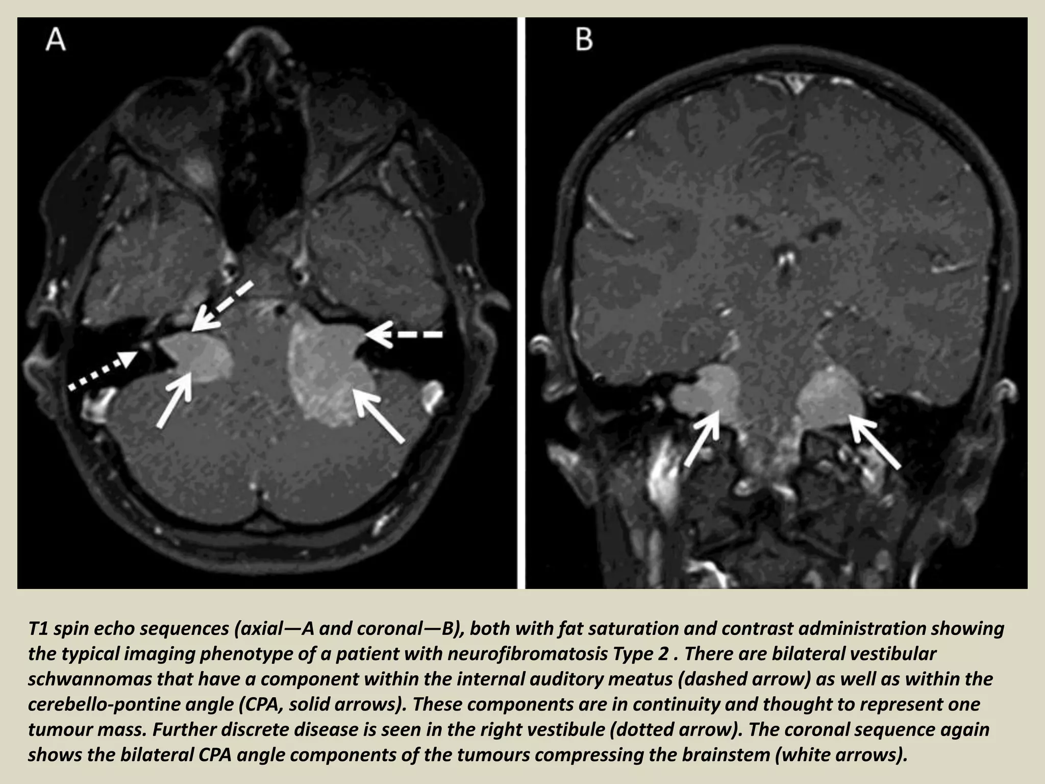 Presentation2, radiological imaging of phakomatosis. | PPTX