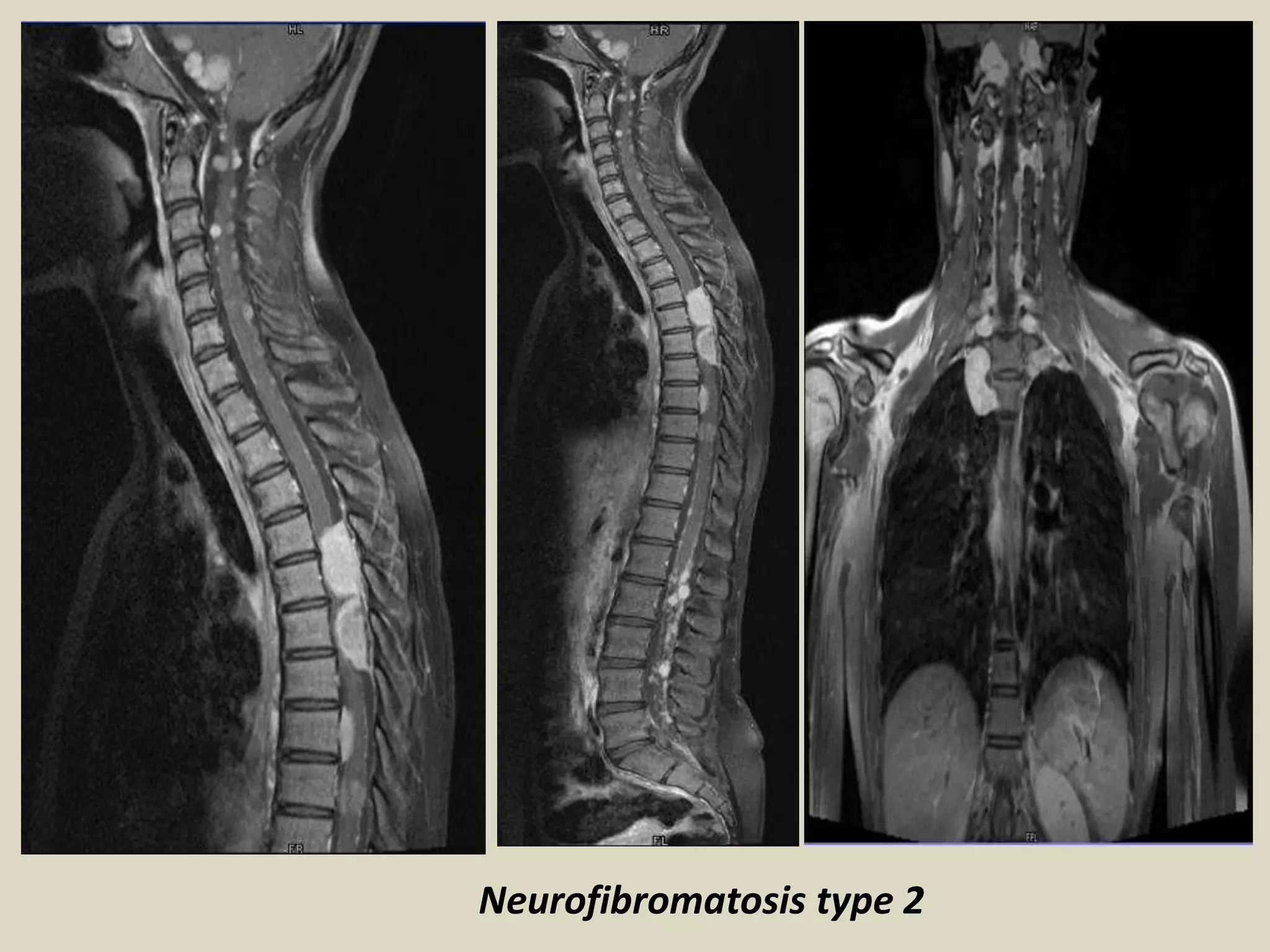 Presentation2, radiological imaging of phakomatosis. | PPTX