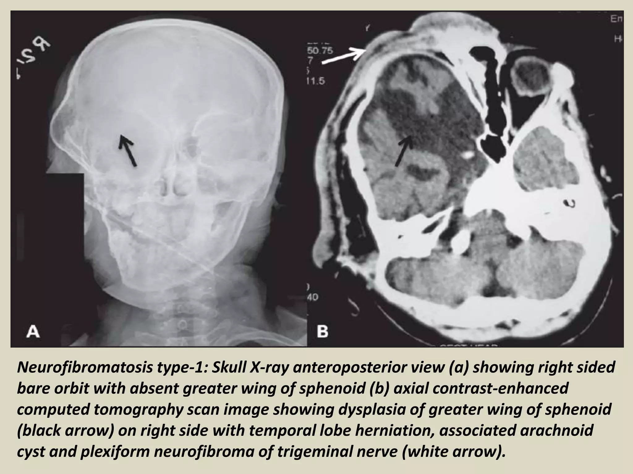 Presentation2, radiological imaging of phakomatosis. | PPTX