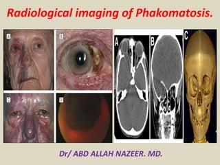 Presentation2, radiological imaging of phakomatosis. | PPTX