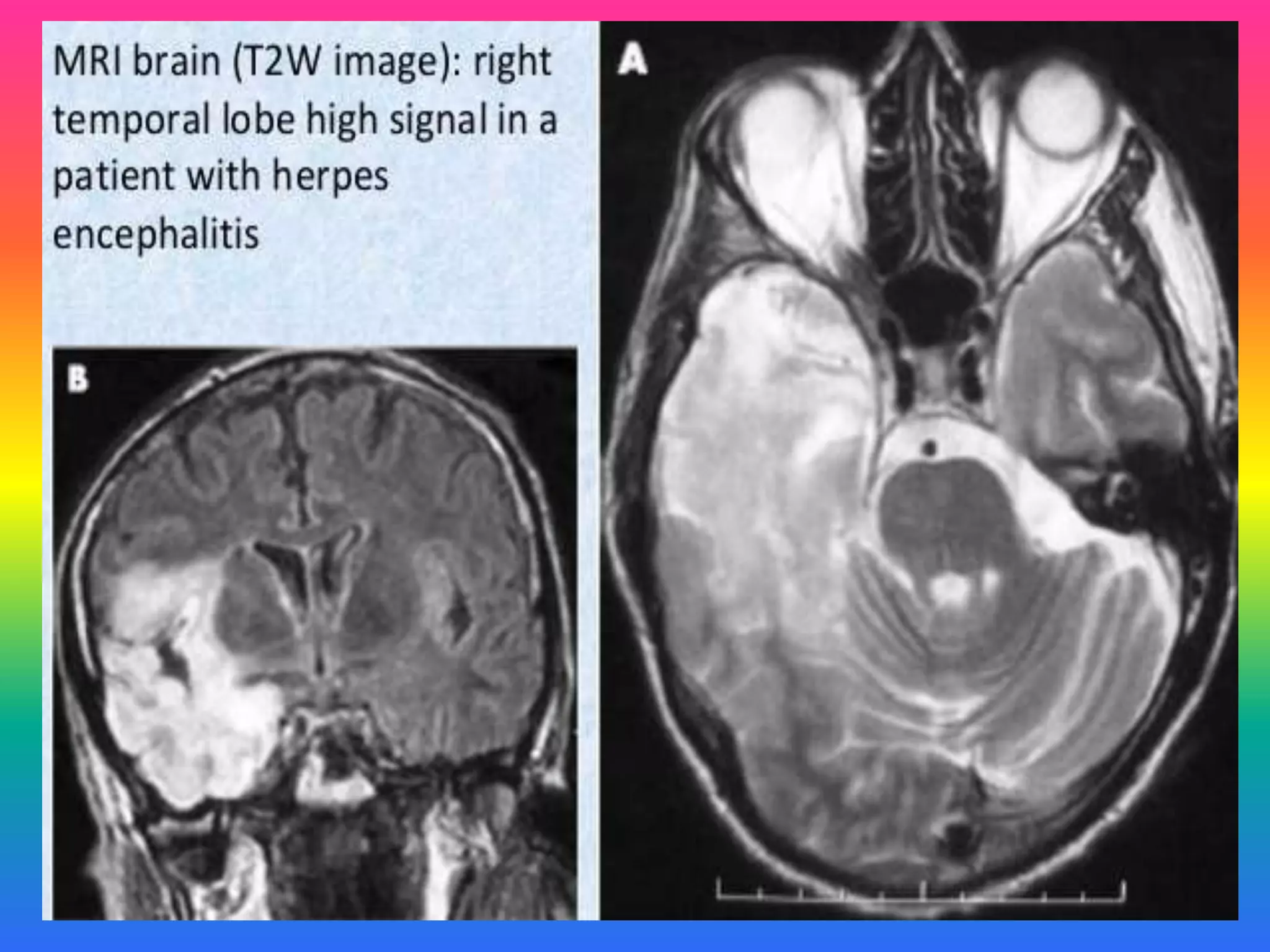 Presentation3.pptx, intra cranial infection. | PPT