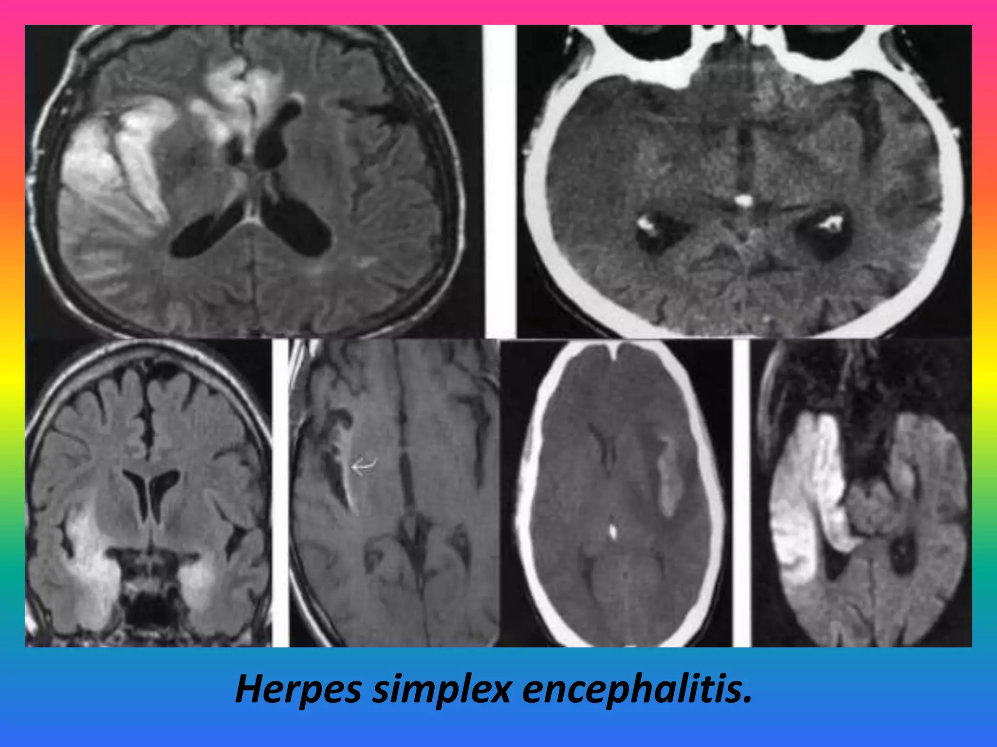 Presentation3.pptx, intra cranial infection. | PPT