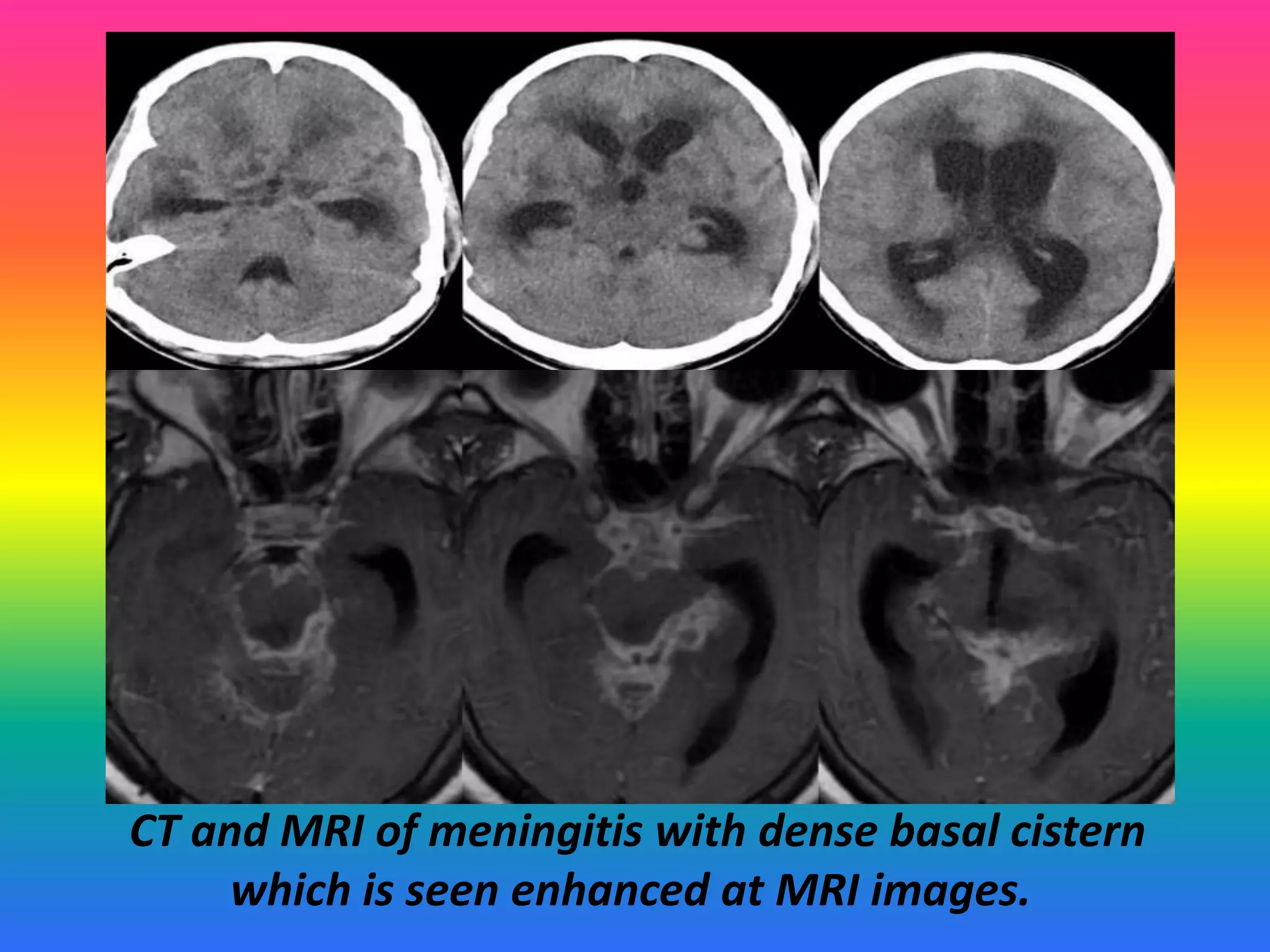 Presentation3.pptx, intra cranial infection. | PPT