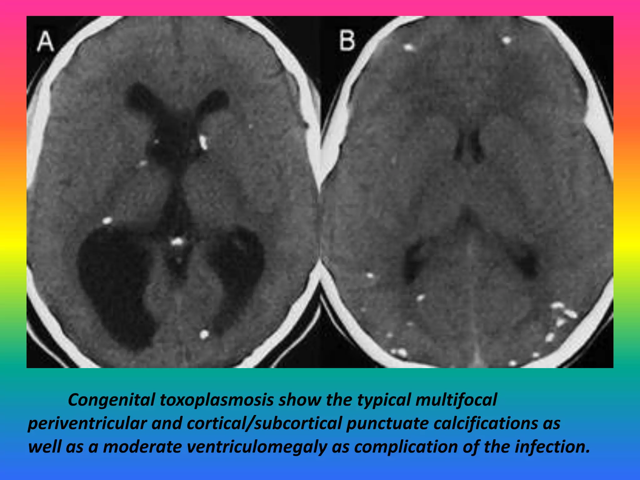 Presentation3.pptx, intra cranial infection. | PPT