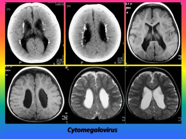 Presentation3.pptx, intra cranial infection. | PPT