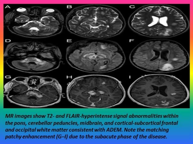 Presentation3.pptx, intra cranial infection. | PPT