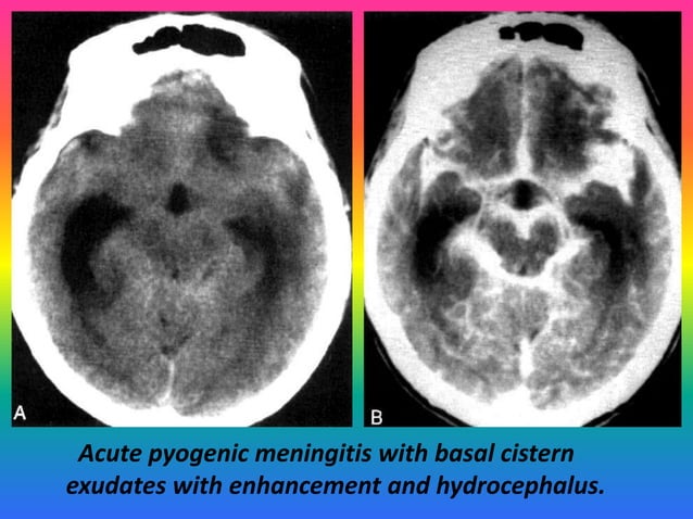 Presentation3.pptx, intra cranial infection. | PPT