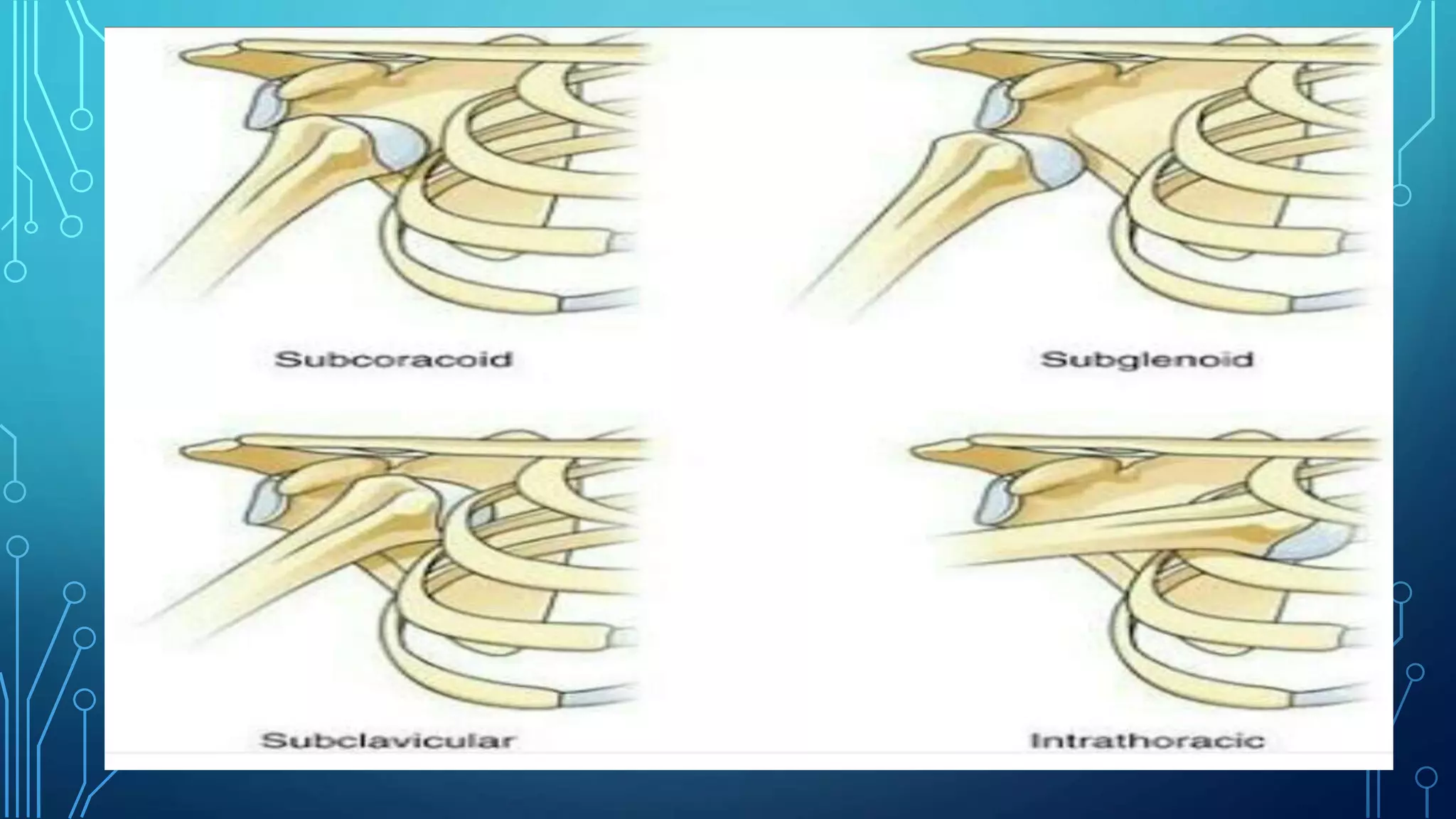 Shoulder dislocation with physiotherapy management | PPTX