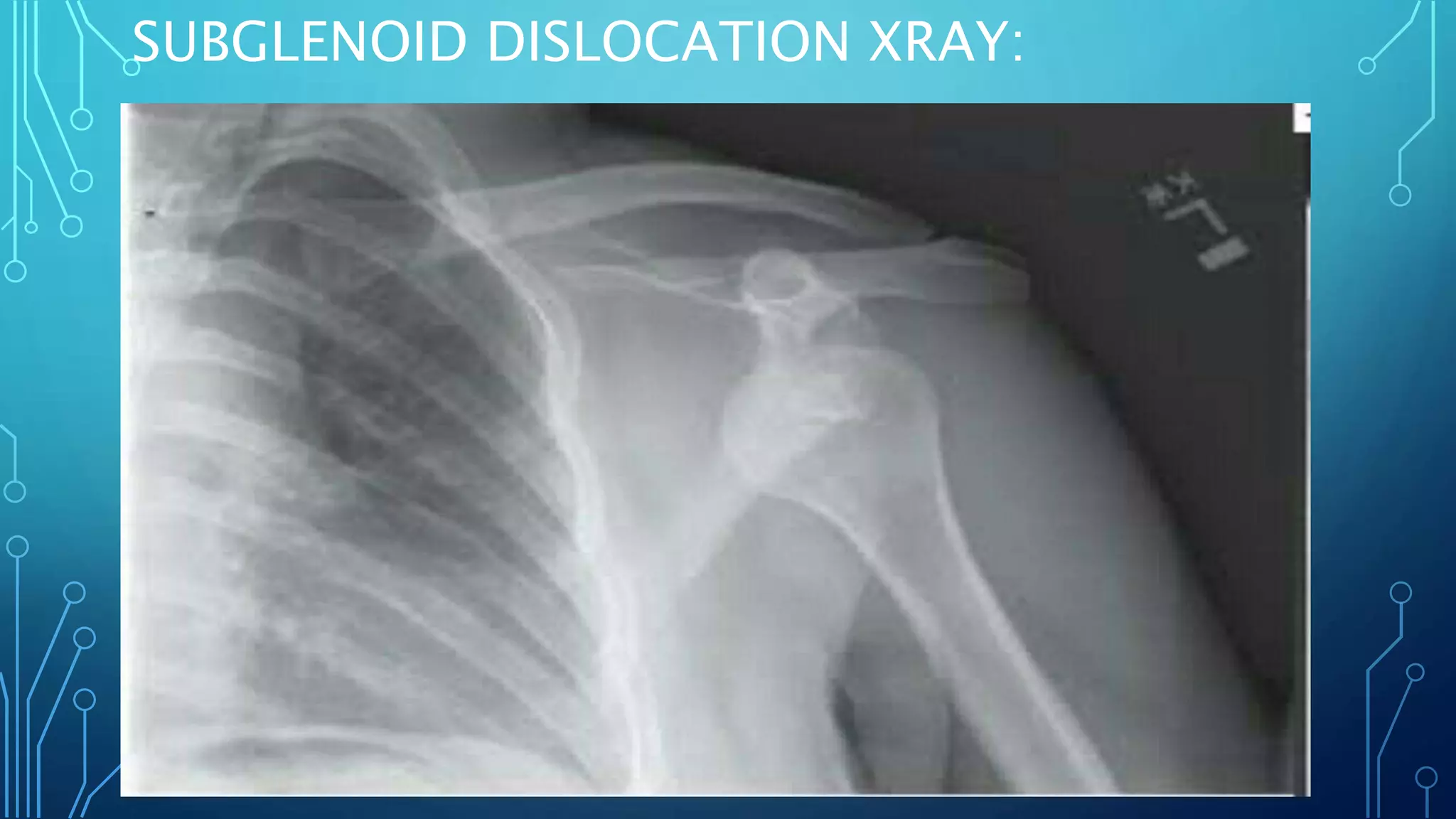 Shoulder dislocation with physiotherapy management | PPTX
