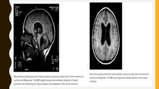 Hydrocephalus | PPTX
