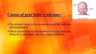 Gray baby syndrome | PPTX
