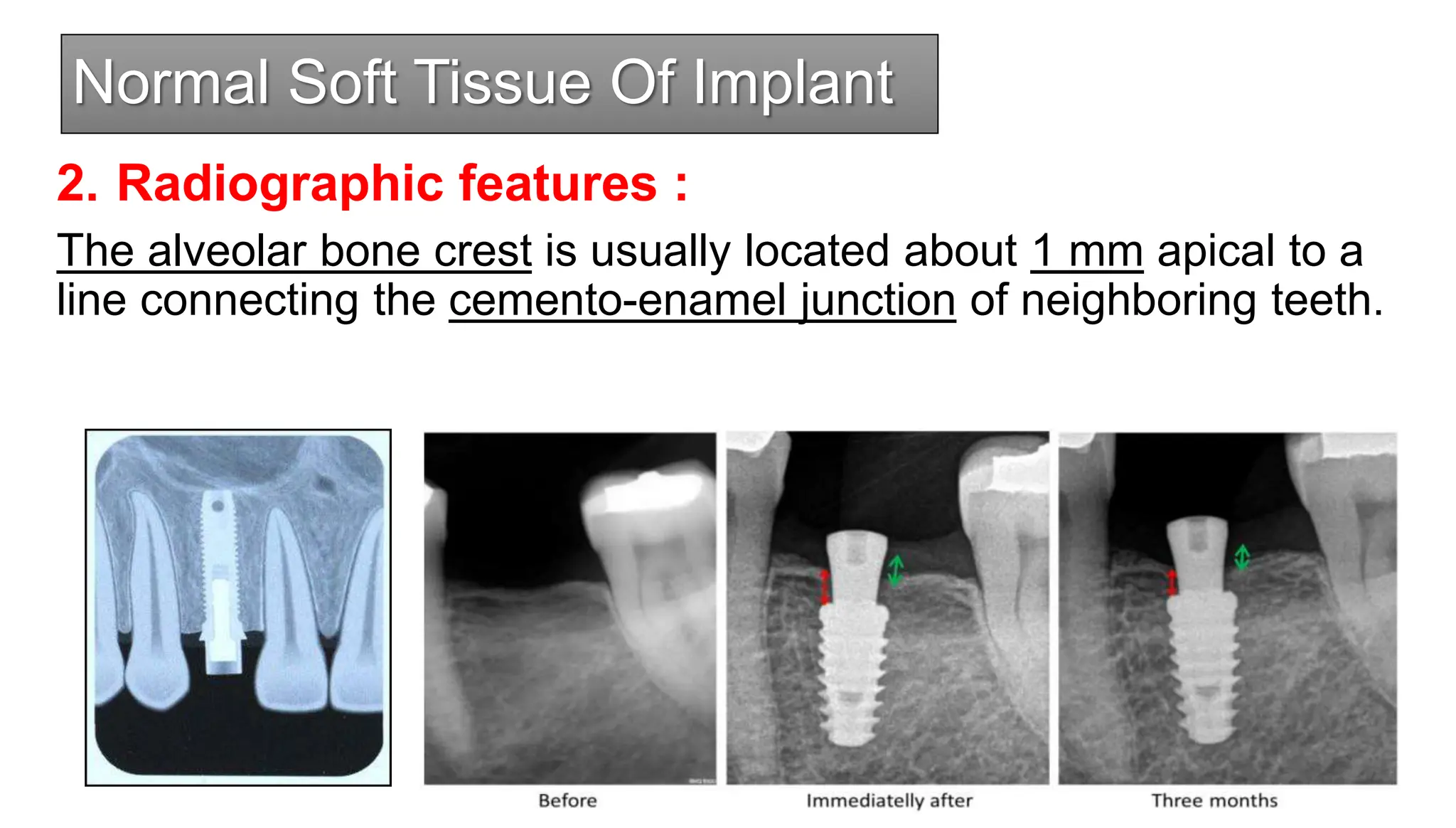 per-implant pathology (per-implanitits + Peri-Implant Mucositis) | PPTX