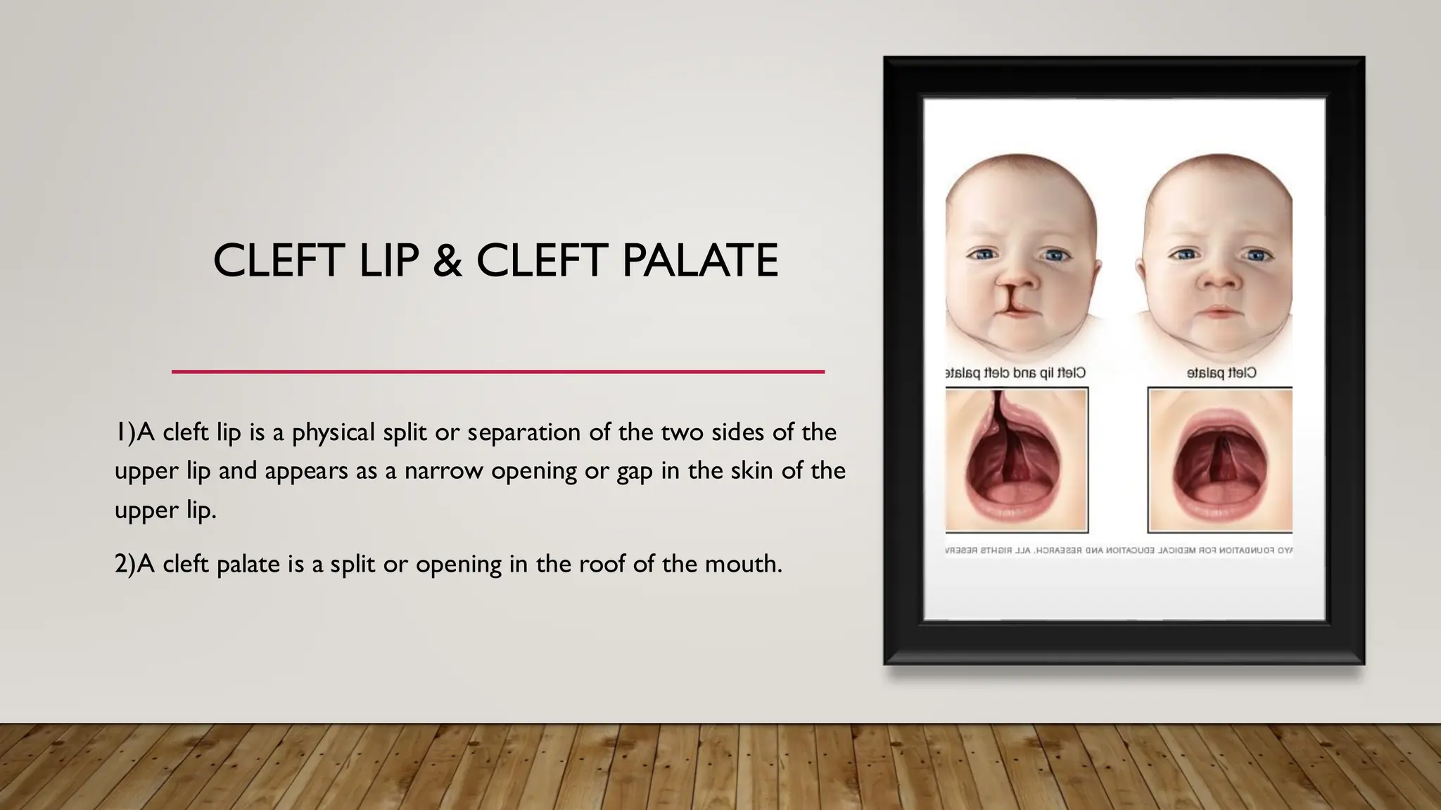 Cleft lip & palate topic. I made this topic simple and clear to you | PDF
