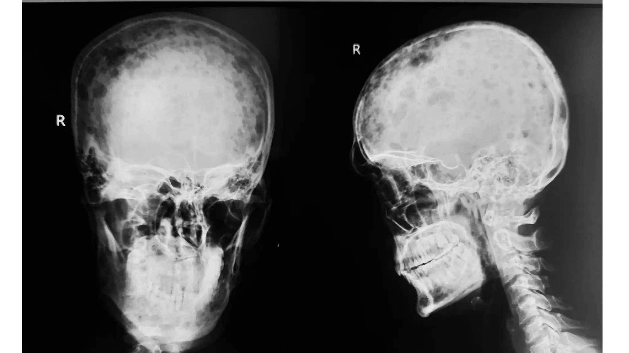 A case presentation of multiple myeloma in skull xray | PPT