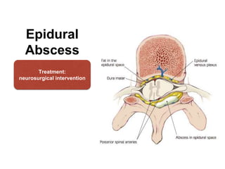 COMPLICATIONS OF SPINAL & EPIDURAL ANAESTHESIA | PPTX
