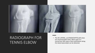 TENNIS ELBOW | PPTX
