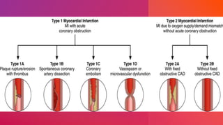 pathophysiology of myocardial infarction | PPTX