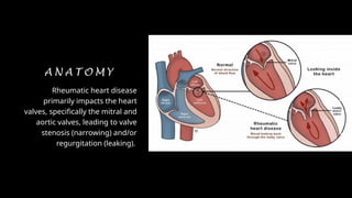 Rheumatic Heart Disease powerpoint for bio anatomy/physiology students ...