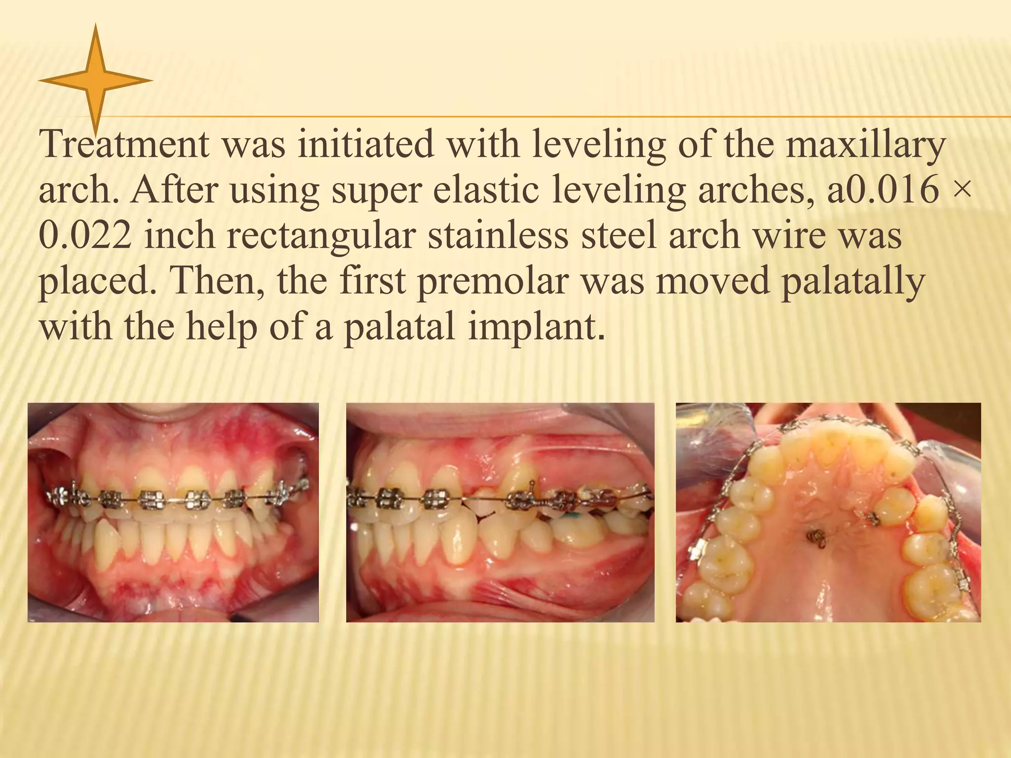 Transposition tooth corrected by orthodontic | PPTX
