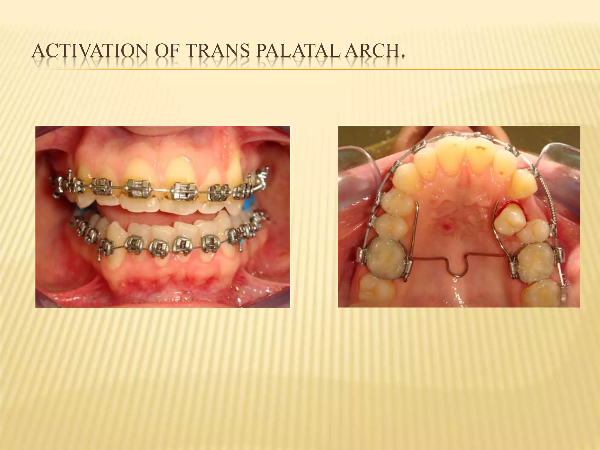 Transposition tooth corrected by orthodontic | PPTX