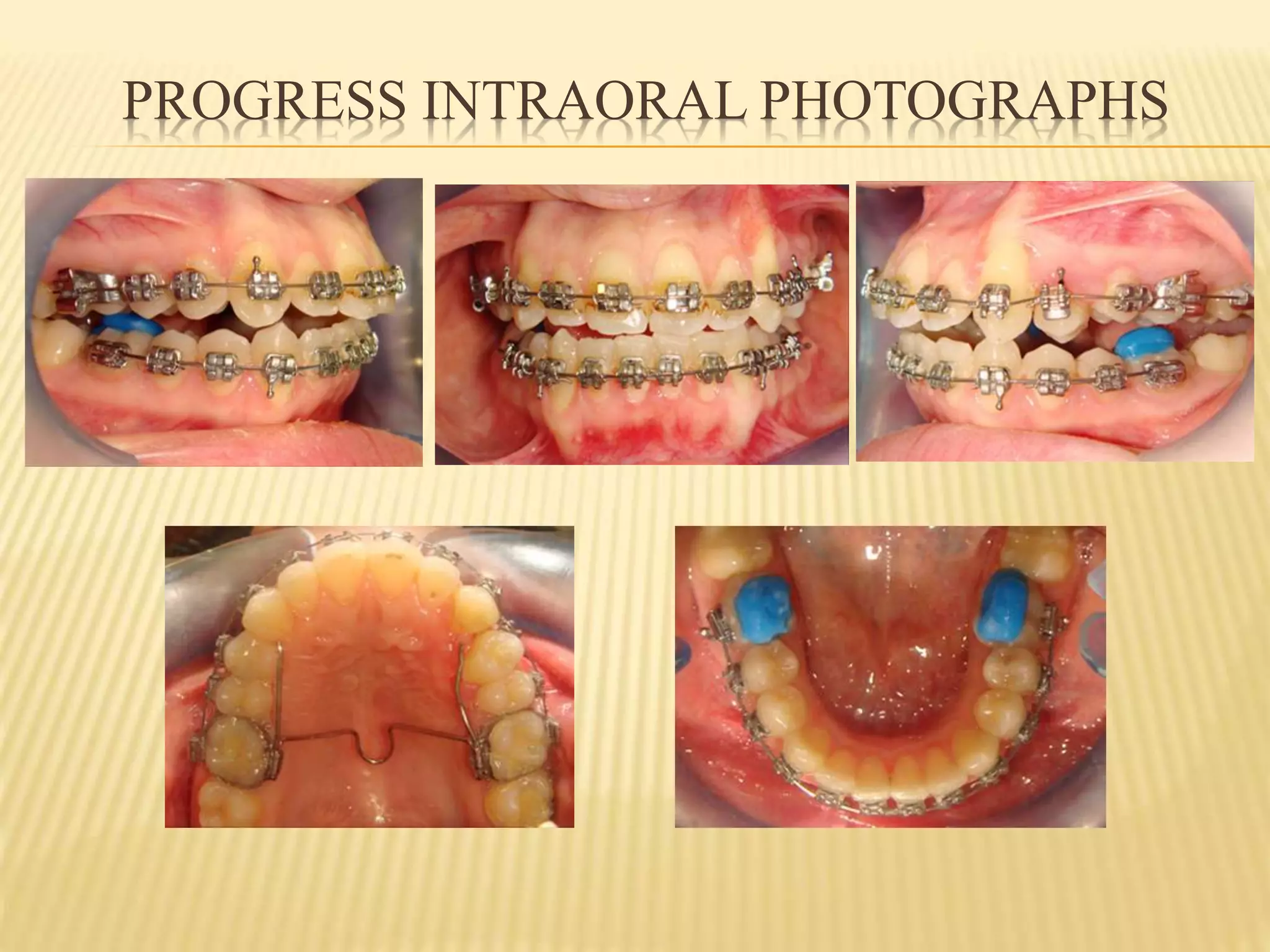 Transposition tooth corrected by orthodontic | PPTX